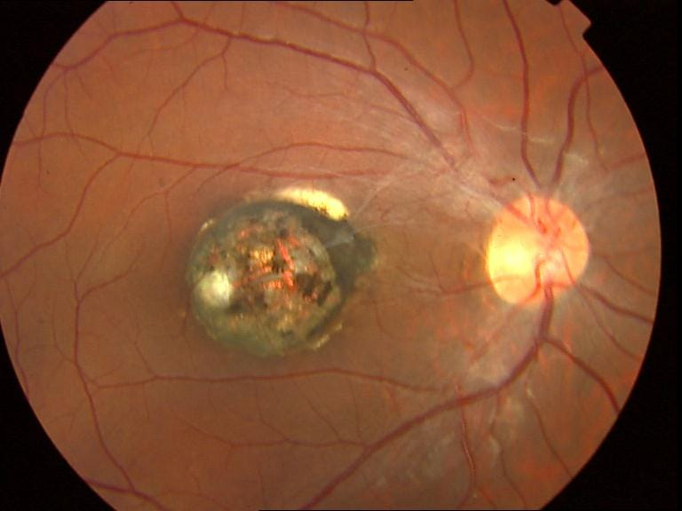 Macular Scar due to Old Chorioretinitis Amritsar Eye Clinic Macular Scar due to Old Chorioretinitis Amritsar Eye Clinic